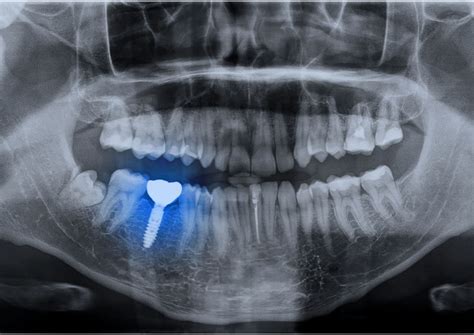 10 CAUSAS DE RECHAZO EN LOS IMPLANTES DENTALES Clínica Alonso