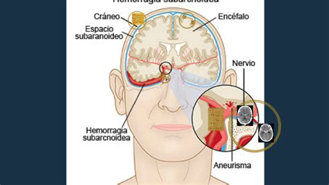 La Hemorragia Subaracnoidea Es El Volcado De Sangre En El Es By Joel