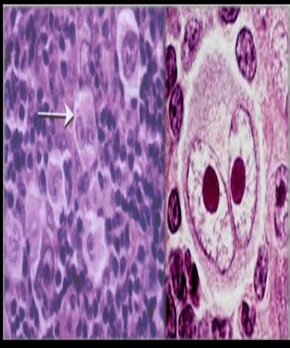 Clin Med Exam Lecture Lymphoid Disorders Flashcards Quizlet