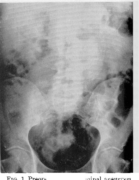 Figure 1 From Dissecting Aneurysm Of The Abdominal Aorta Treated By