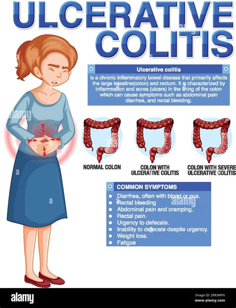 Chronische Colitis Ulcerosa Stock Vektorgrafiken Kaufen Alamy