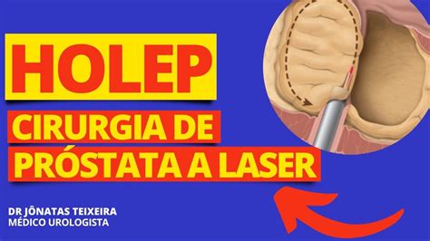 HoLEP CIRURGIA DE PRÓSTATA A LASER PARA PRÓSTATA AUMENTADA UROLOGISTA