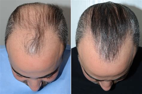 What Are Men Hair Plugs