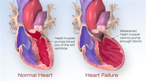 Congestive Heart Failure CHF Risk Factor Prevention Treatment