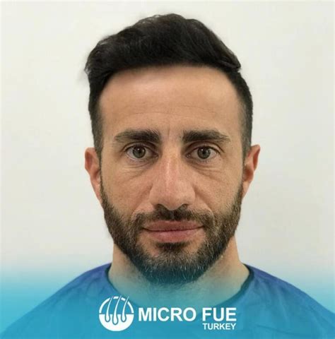 Hair Transplant Bodrum Bodrum Holiday