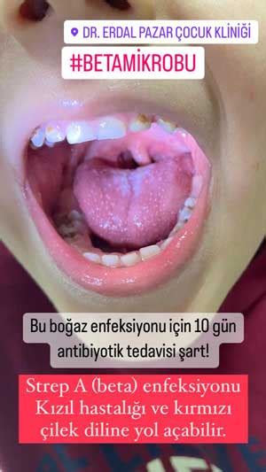 STREP A ENFEKSİYONLARI Uzm Dr Erdal Pazar