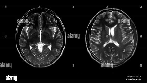 Mri Brain Scan Normal Hi Res Stock Photography And Images Alamy