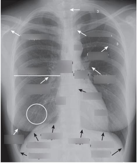 Chest Xray ID Frontal Anatomy Diagram Quizlet