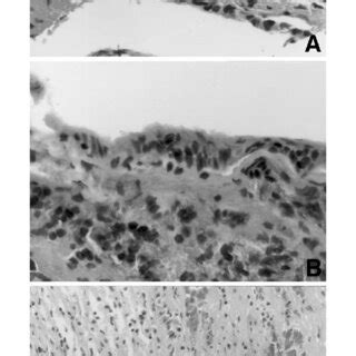 A Photomicrograph Of The Surgical Specimen Showing The Cyst Wall