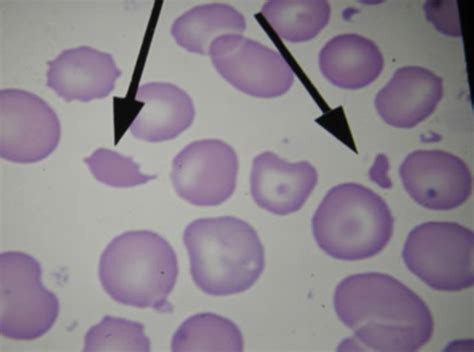Blood Disorders Rbc Wbc Platelets Flashcards Quizlet