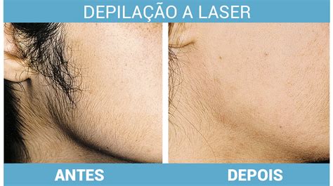 Valor Da Depila O A Laser Em