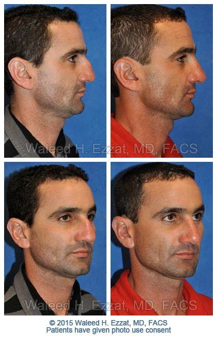 Trabajo De Nariz Para Hombres Trabajo De Nariz Rinoplastia Avenir