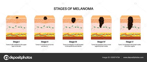 Estadios Del Desarrollo Progresi N Del C Ncer Piel Melanoma Crecimiento