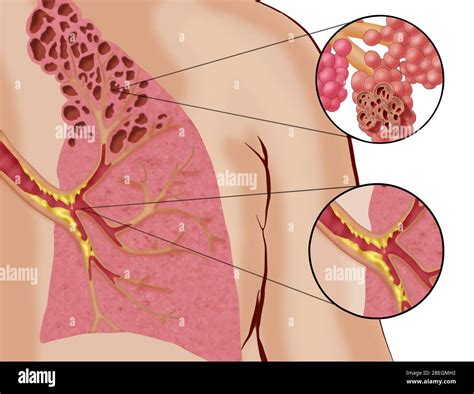 Enfermedad pulmonar obstructiva crónica EPOC Fotografía de stock Alamy
