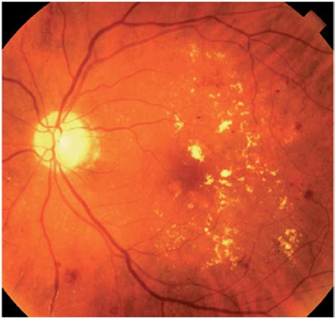 Non Proliferative Diabetic Retinopathy