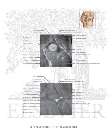 Cross Section Of The Hip Coronal Oblique View