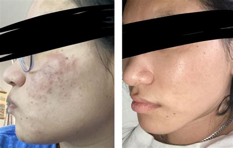 Before And After 1540 Laser Treatments For Rosacea And Acne Scarring