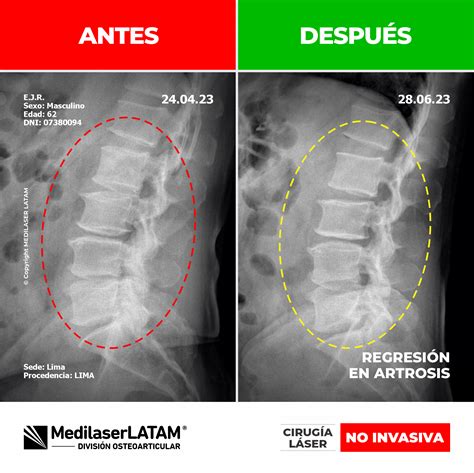 Enrique Jurado Regresi N En Artrosis Medilaser Per