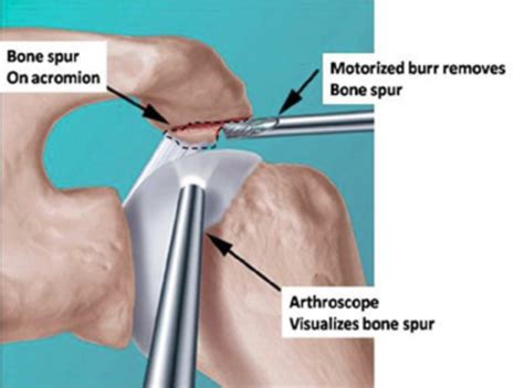 Shoulder Impingement Dr Erik Hohmann
