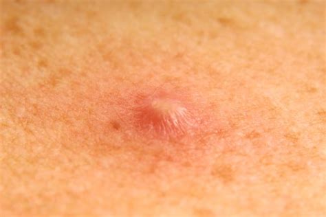 Sebaceous Cyst What It Is Symptoms And How To Treat It HSBIR