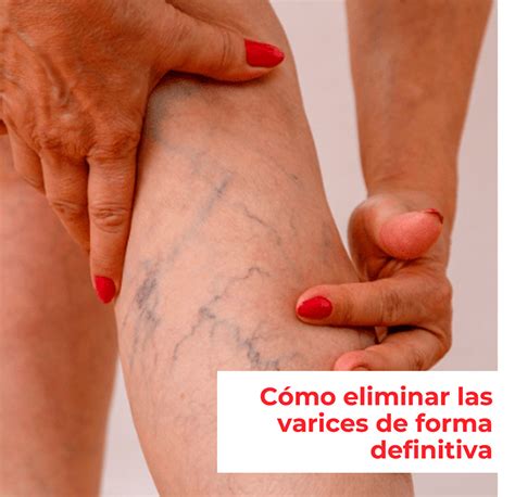 Lista 101 Foto Varices Con Láser Antes Y Después Cena Hermosa