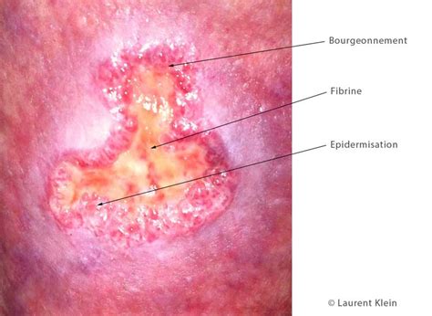 Débridement détersion des plaies par l infirmière pourquoi quand le
