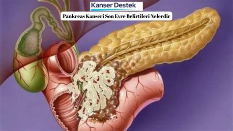 Pankreas Kanseri 4 Evre Belirtileri Listesi Kanser Destek