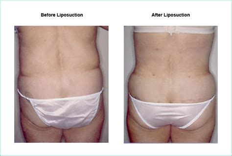 Tumescent Surgery Fat Removal Surgery Austin Texas Ctd