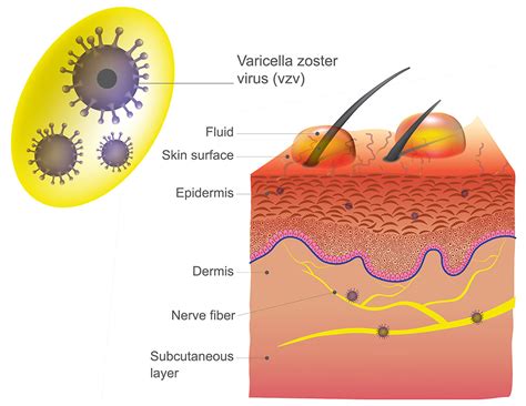 Chickenpox And Shingles Vaccinations Vitalia Healthcare Clinic