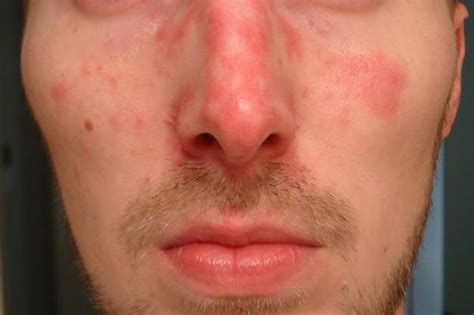 Why Does My Face Get Red And Hot So Easily At Richard Goodwin Blog