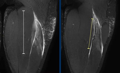 The Radiology Assistant Hamstring Injury