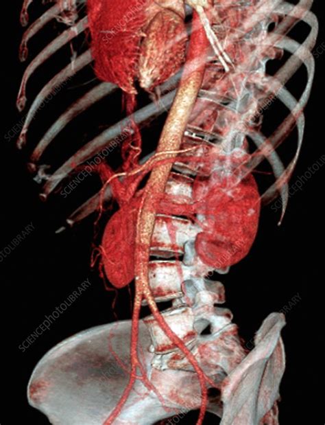 Normal Abdomen 3D CT Scan Stock Image F003 9191 Science Photo