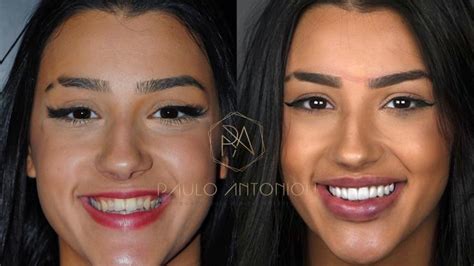 Neta de Gretchen aparece irreconhecível após harmonização facial