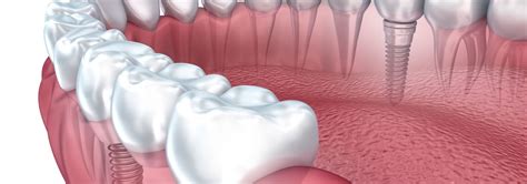 Basal Implants Cost The Lowest In The World Dr Motiwala Dental