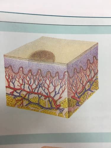 Skin Lesions Flashcards Quizlet
