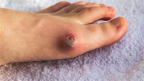 PAD Symptoms Non Healing Arterial Foot Leg Toe Ulcers USA
