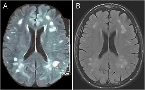 Cerebral Edema Images