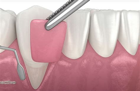 Encías retraídas Síntomas causas y tratamiento Clínica dental