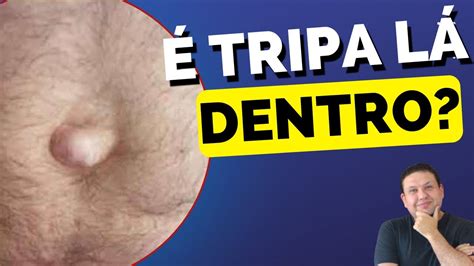 O Que Tem Dentro Da H Rnia Umbilical A Tripa Que Fica Dentro Da