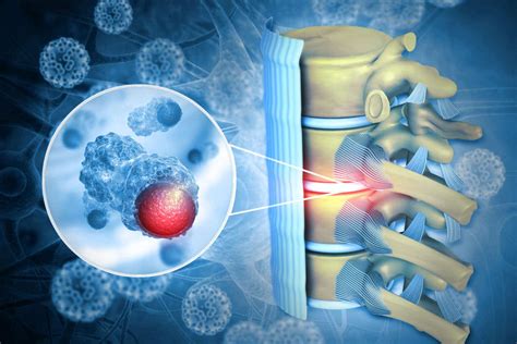 Spinal Tumor Hart Garner MD Minnesota Spinal Neurosurgeon