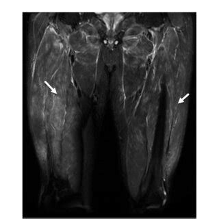 Magnetic Resonance Imaging Scan Of The Patient S Thigh Muscles Coronal