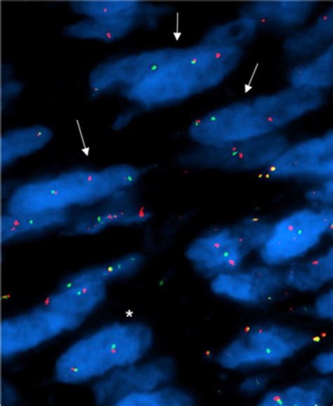 Interphase Fluorescent In Situ Hybridization Using A Dual Color Showing