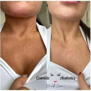 Profhilo Before And After Photos Australia Bio Remodelling Filler