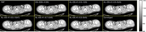 figure 1 from combining augmented lagrangian method with ordered subsets for x ray ct