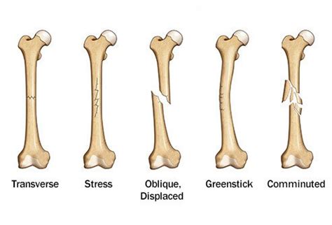 Bone Fracture Doctor In Dahisar Fracture Treatment In Dahisar