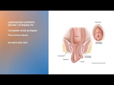 Laparoscopic Dorsal Rectopexy In Complete Rectal Prolapse Step By Step
