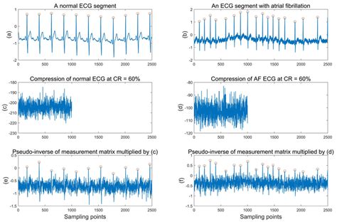 an example of compressed sensing of normal ecg segment and af ecg download scientific diagram