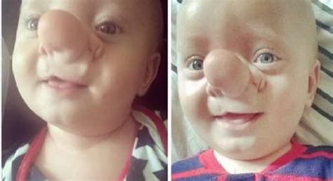 Moqué pour son nez malformé à la naissance voici à quoi le petit