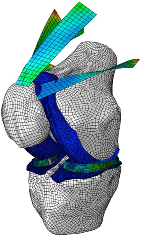Lateral Release Associated With MPFL Reconstruction In Patients With
