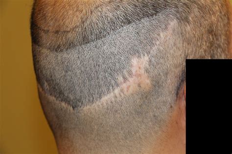 Botched Hair Transplant Surgeries Continue To Rise Modena Hair Institute